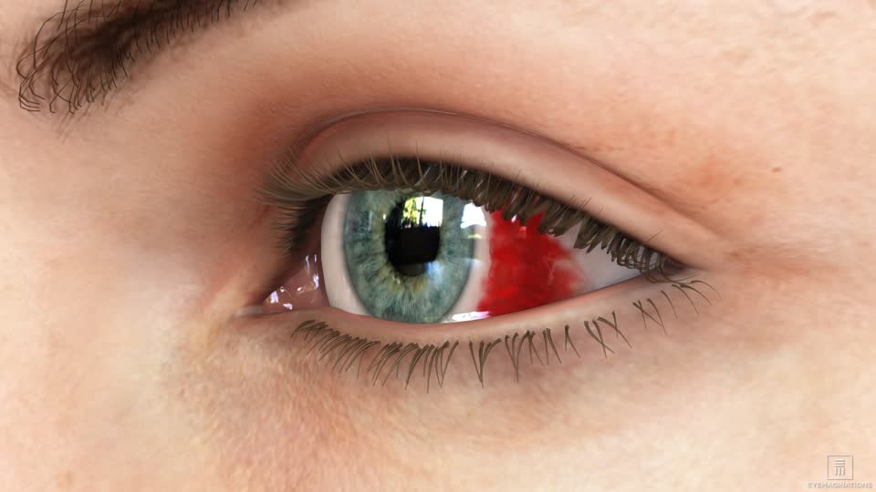 Subconjunctival Hemorrhage